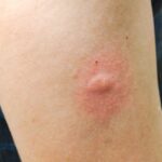 Healthy travel in Costa Rica: Avoiding mosquito bites